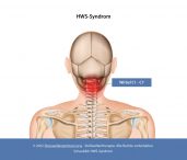 📶 HWS-Syndrom - Symptome & Therapie - Stoßwellenzentrum NRW