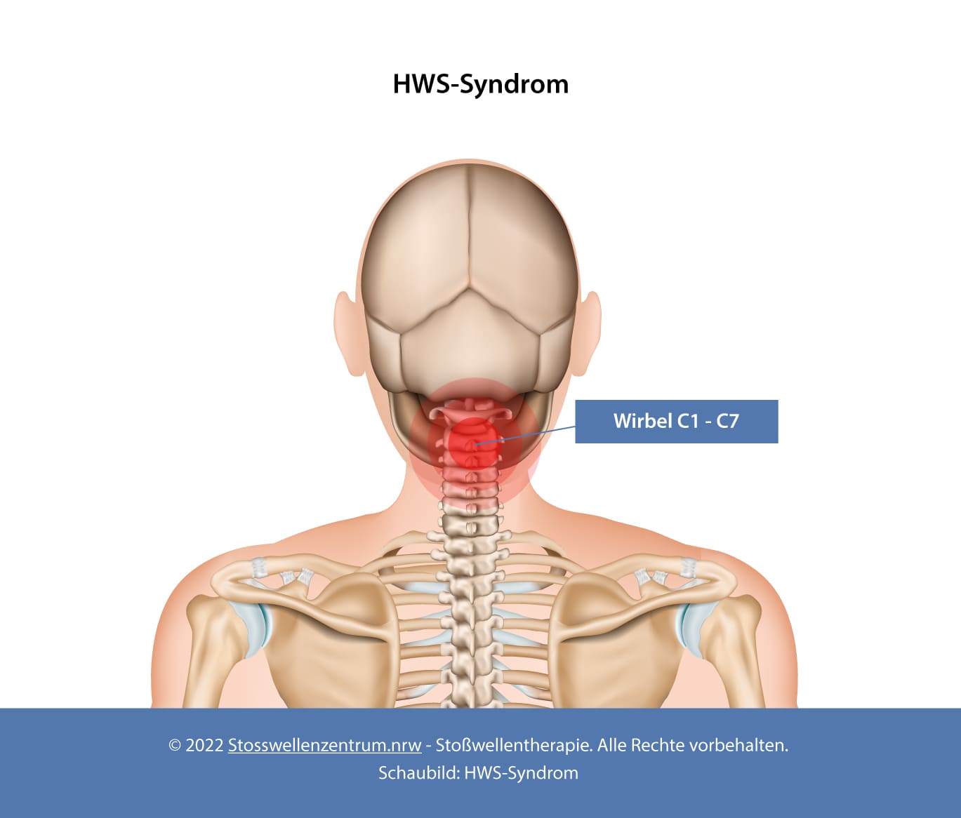 📶 HWS-Syndrom - Symptome & Therapie - Stoßwellenzentrum NRW