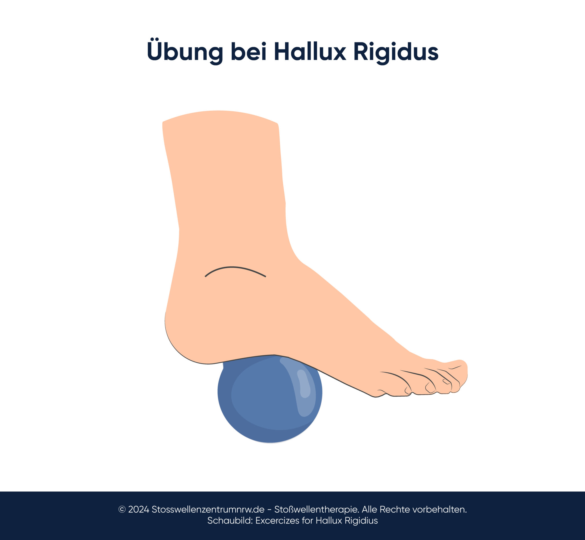 Hallux Rigidus - Was hilft bei Schmerzen am großen Zeh ...