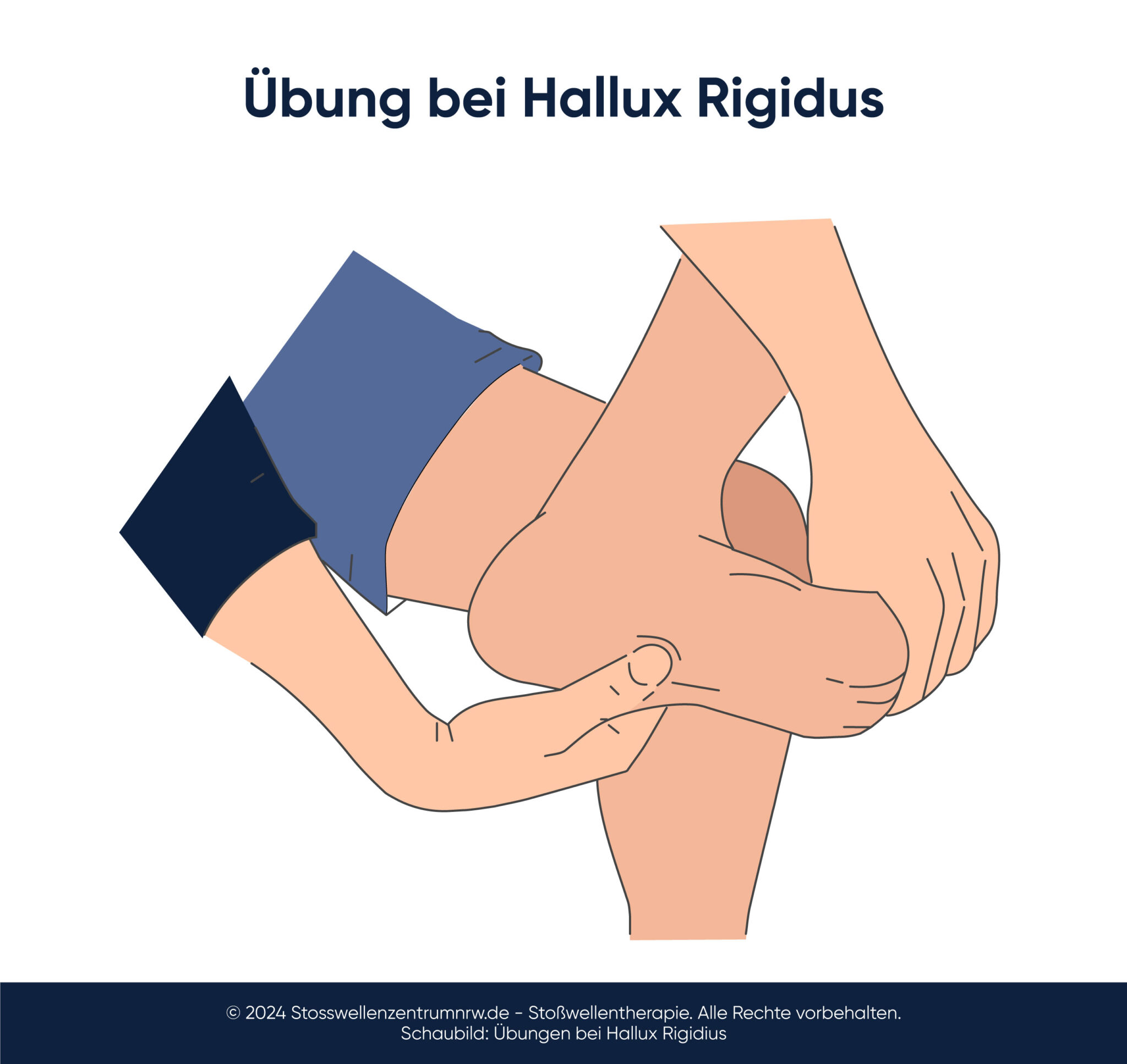 Hallux Rigidus - Was hilft bei Schmerzen am großen Zeh ...