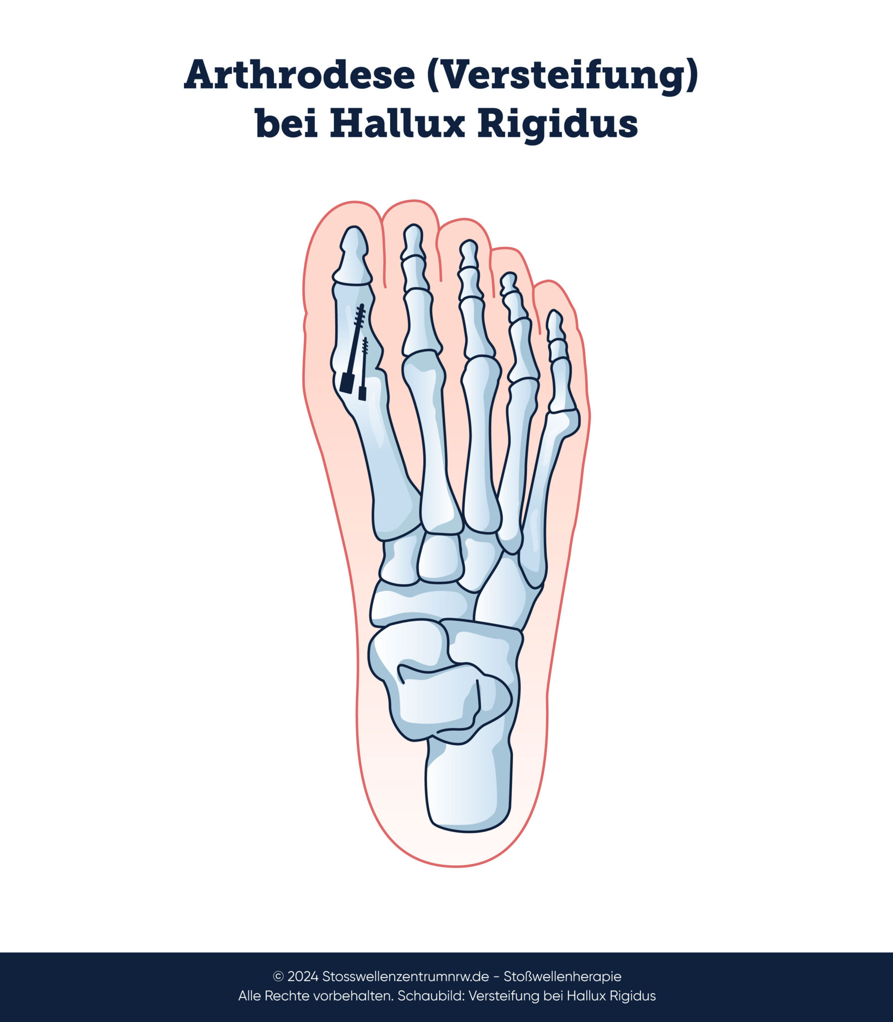 Hallux Rigidus - Was hilft bei Schmerzen am großen Zeh ...
